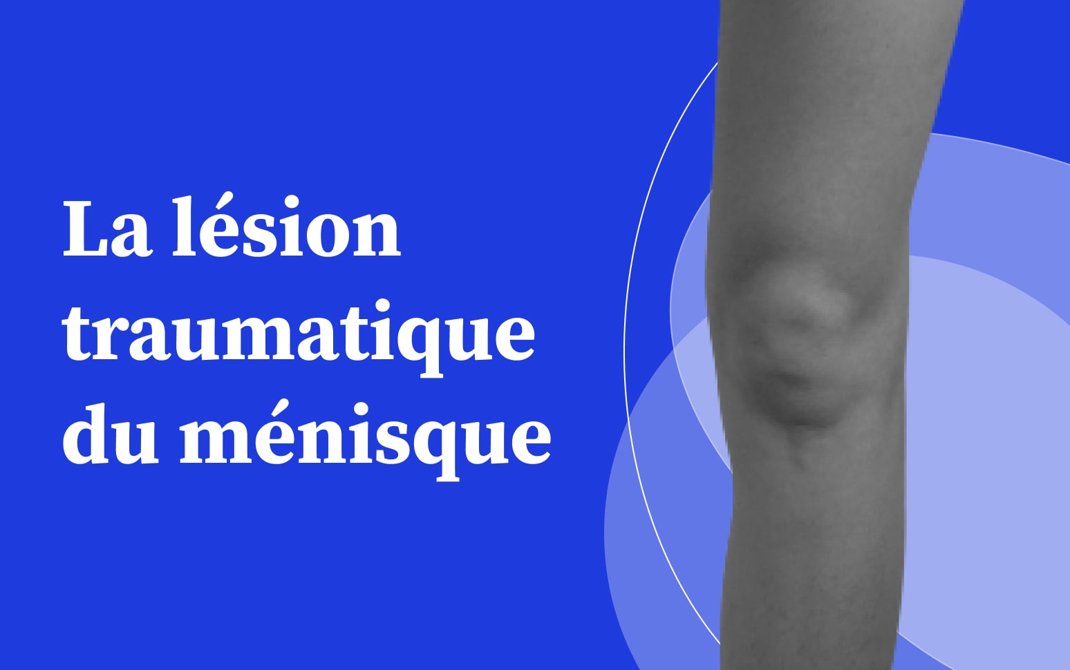 La lésion traumatique du ménisque