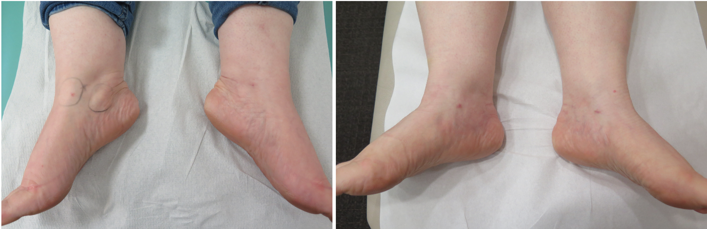 Liposuction Birmingham | Kat & Co