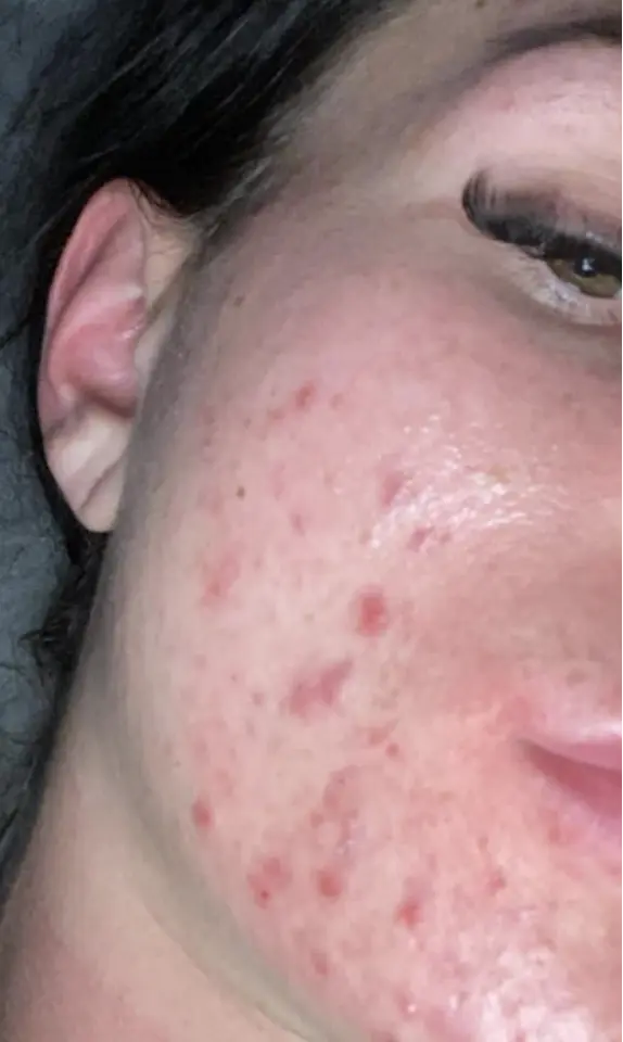 Clinical Strength Acne Treatment | Software