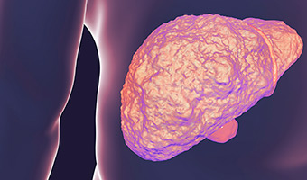 Story | Hadassah Study Sheds Encouraging Light in Treating Liver Disease