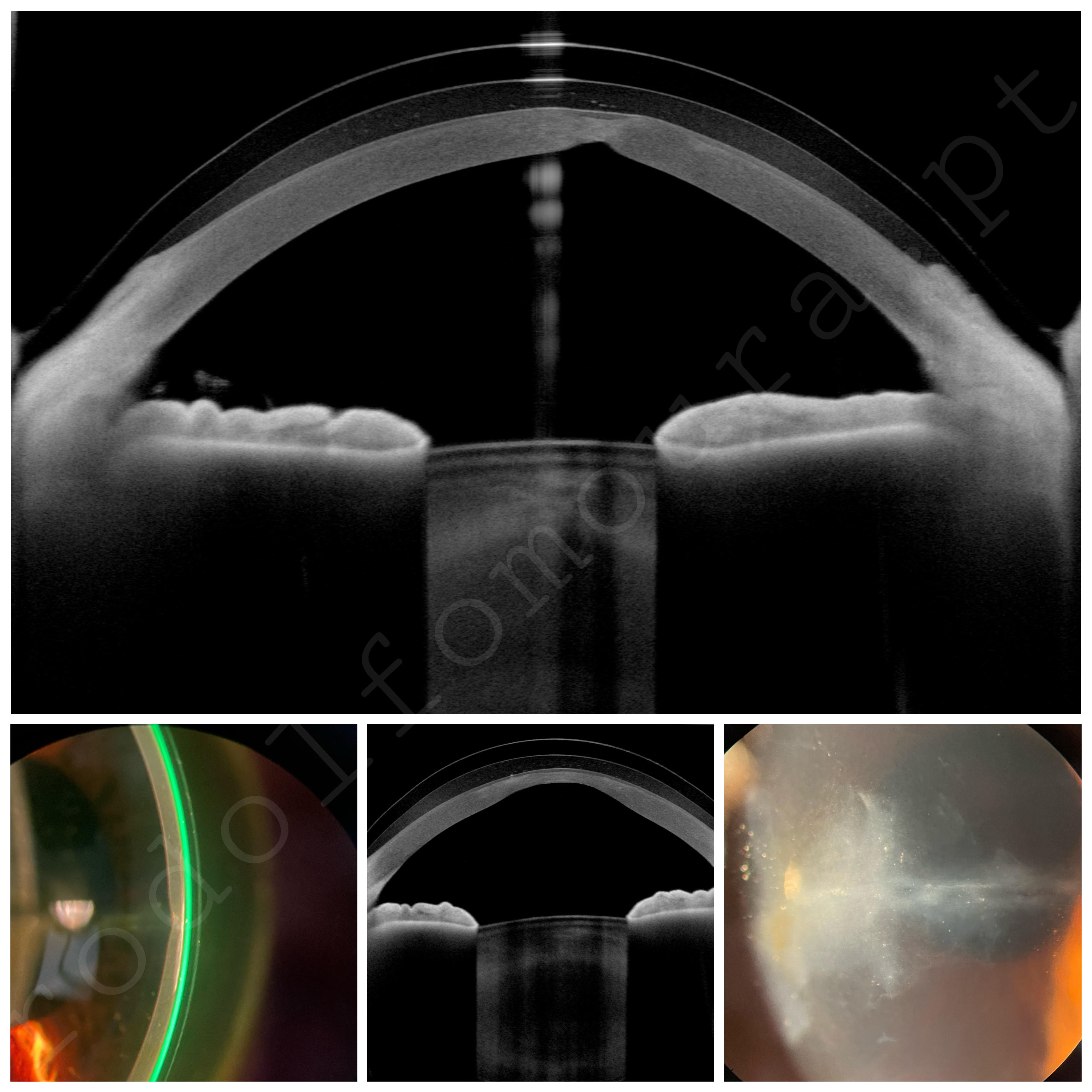 Perfuração Ocular corrigida com Lente de Contacto Escleral - Rodolfo ...