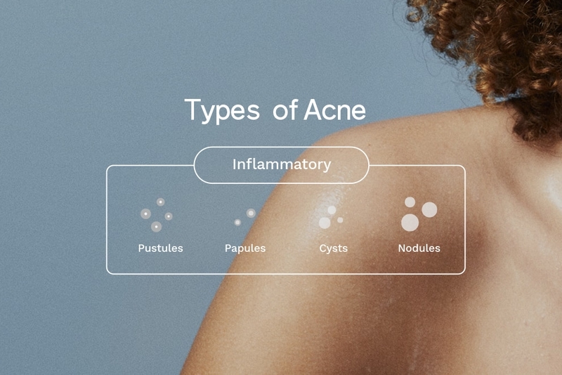 Everything you need to know about acne vulgaris - Skin Journal - Software