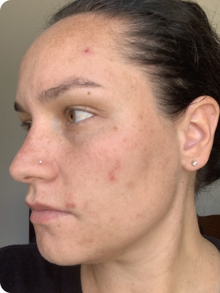 Clinical Strength Acne Treatment | Software