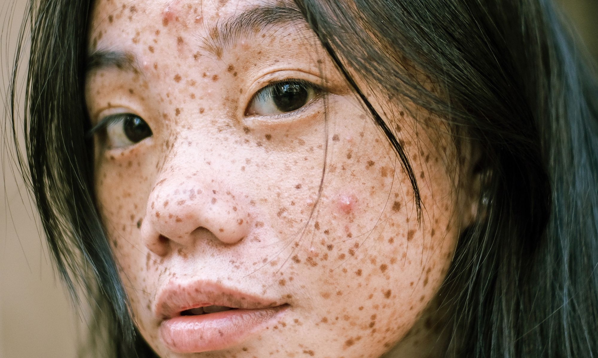 All About Solar Lentigo & How To Treat It | Software