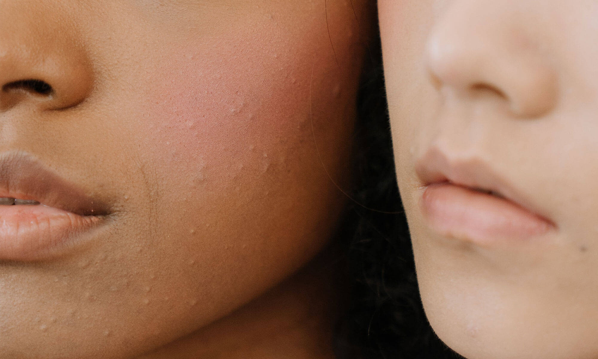 Do Pimple Stickers Actually Work? What You Need to Know | Software