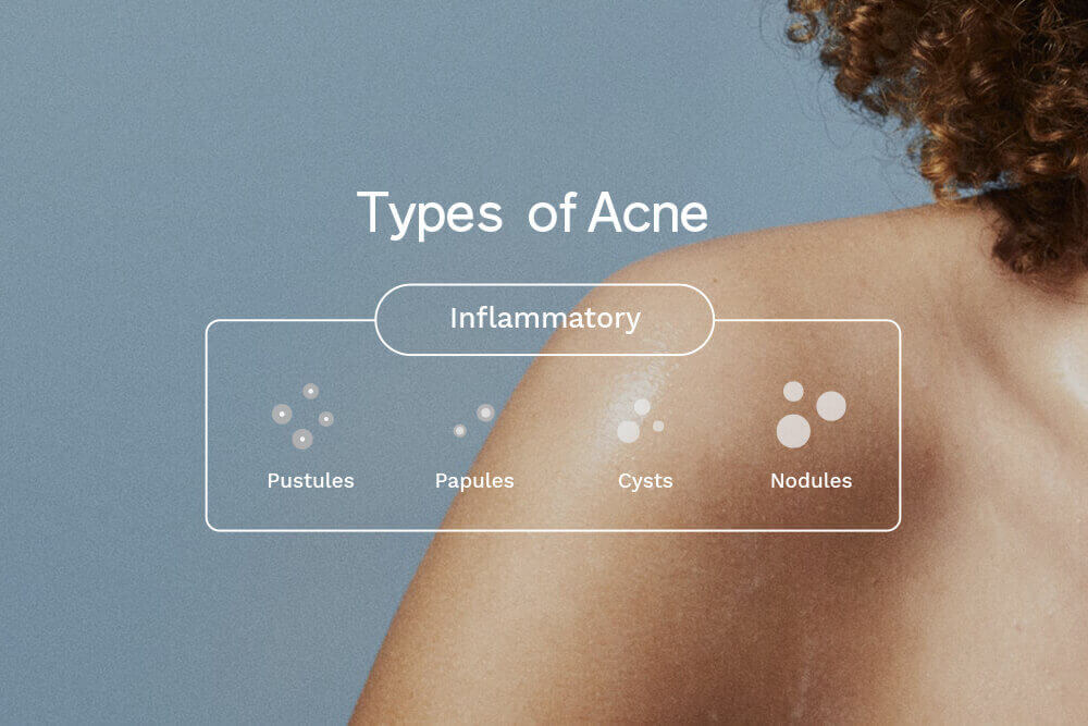 Acne Vulgaris: Everything You Need to Know | Software