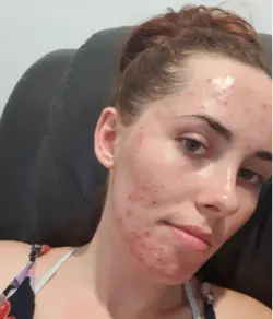 Clinical Strength Acne Treatment | Software