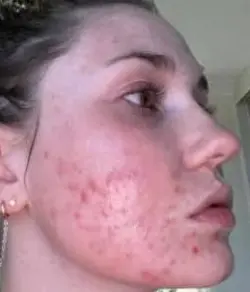Clinical Strength Acne Treatment | Software