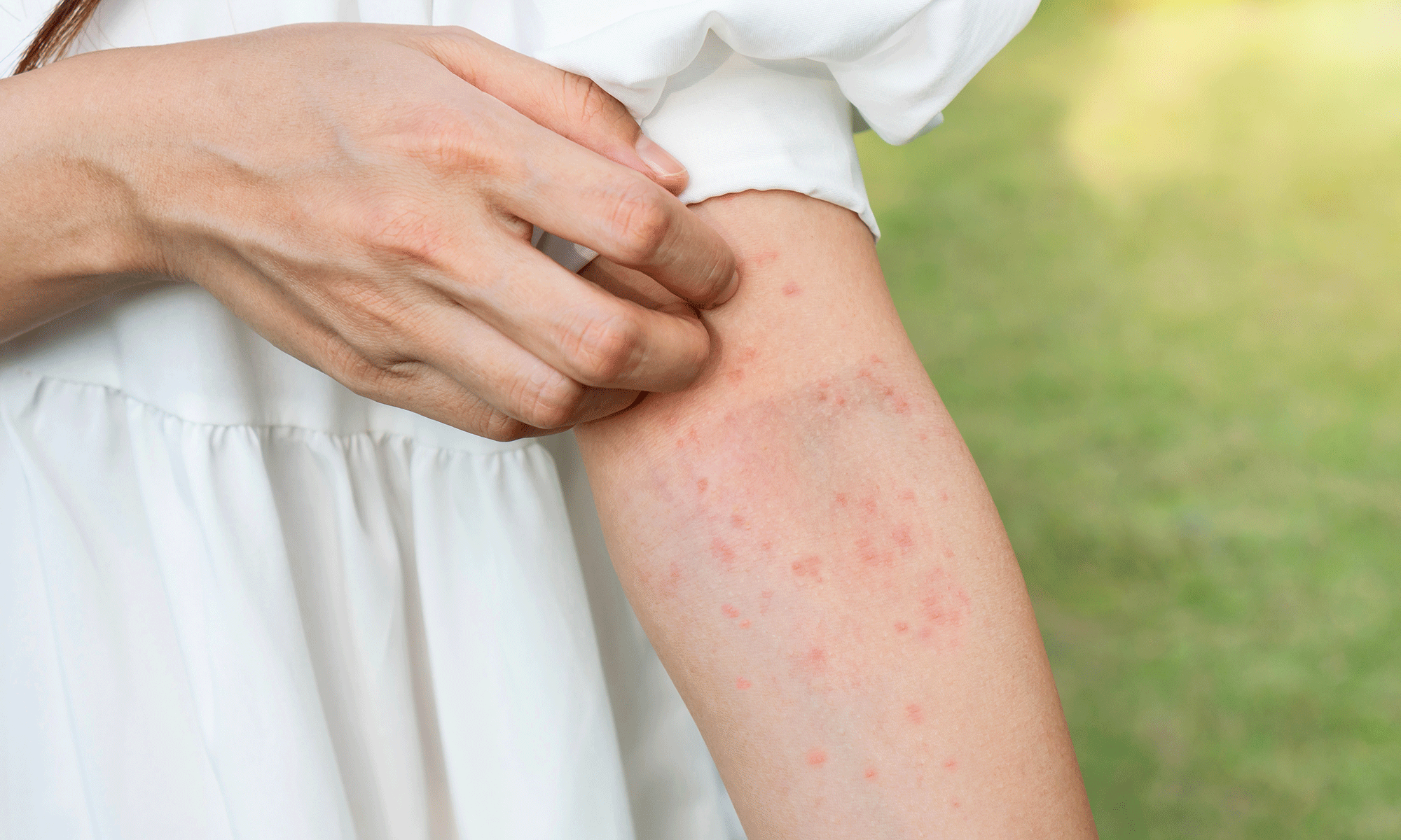 Eczema vs Psoriasis: What's the Difference and How to Treat These Skin ...