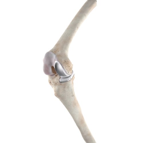 SIGMA® High Performance Partial Knee System