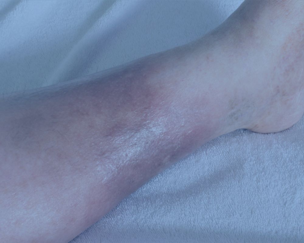 The 5 Most Effective Treatments for Lower Extremity Ulcers | Blog ...