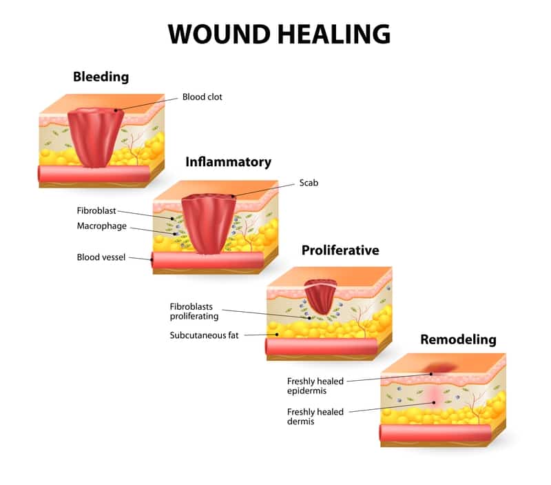 Benefits and Limitations of Placental Tissue for Wound Healing