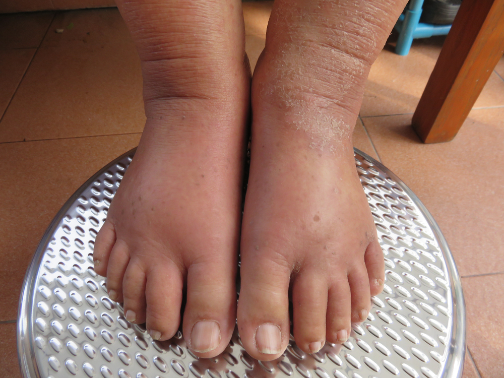 Edema In Chronic Wounds Risk Factors Diagnosis And Treatment