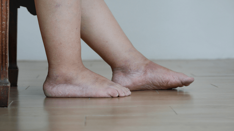 Charcot foot 101: Definition, Stages, Symptoms, and Diagnosis