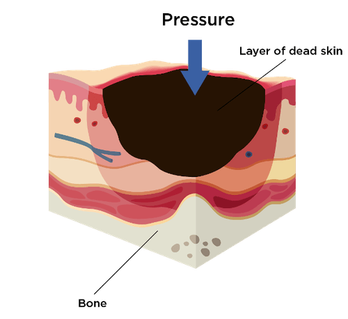 Demystifying Unstageable Pressure Ulcers
