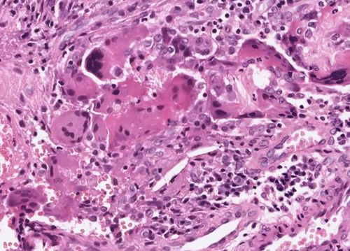 Granulation Tissue: What You Need To Know