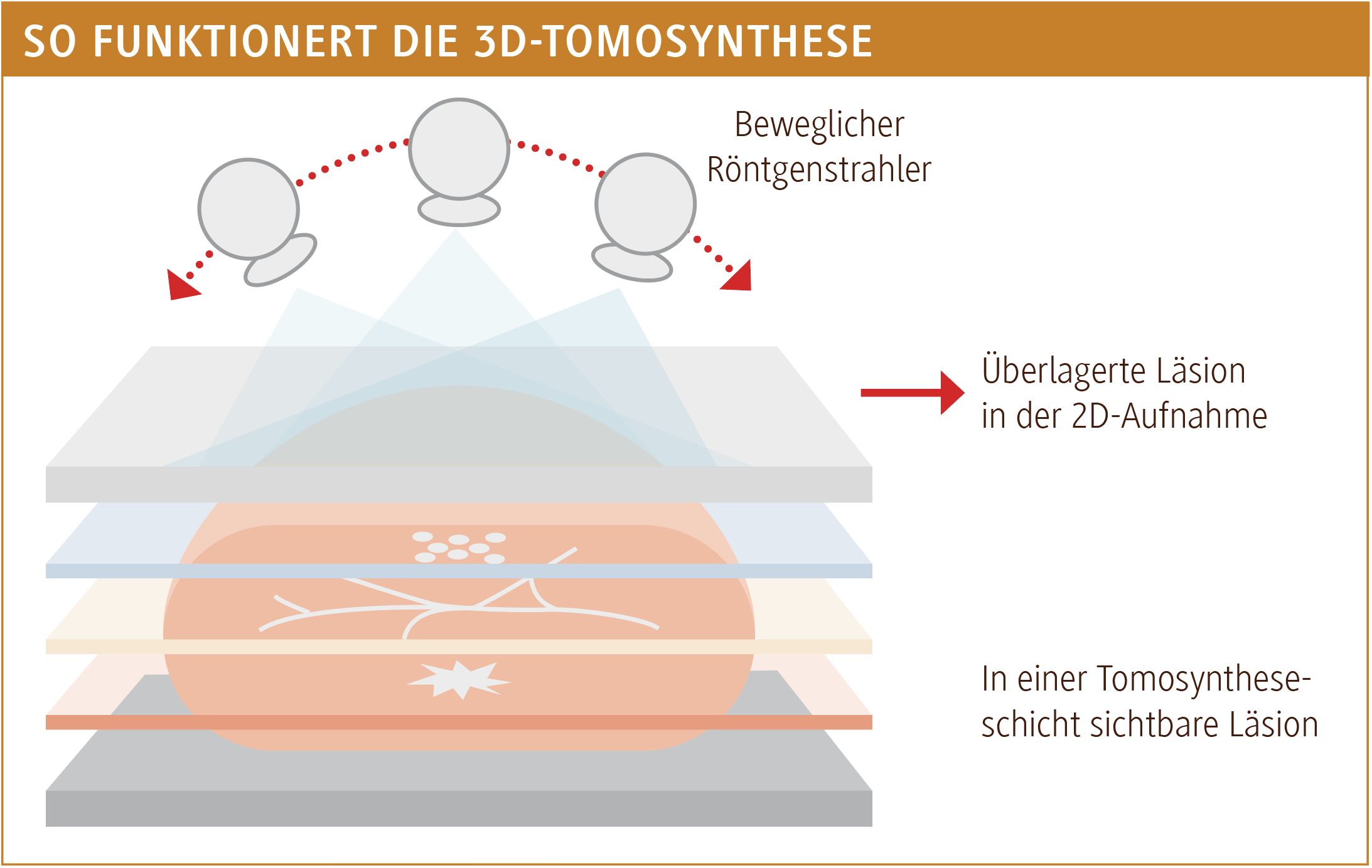 3D-Tomosynthese bietet klare Diagnostik-Vorteile