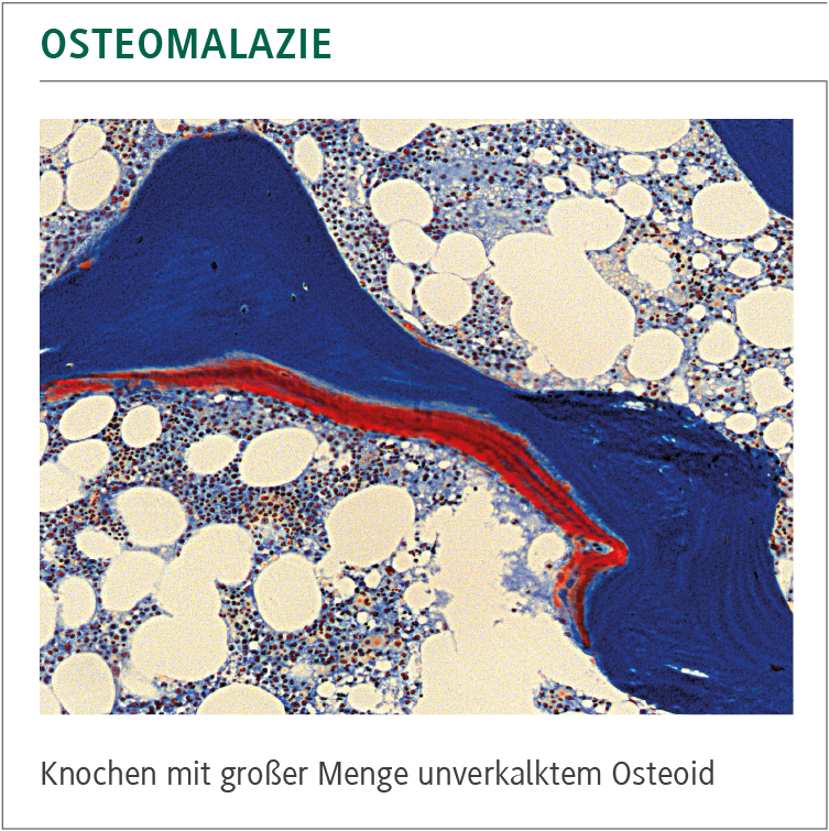 Mit Vitamin D gut zu therapieren