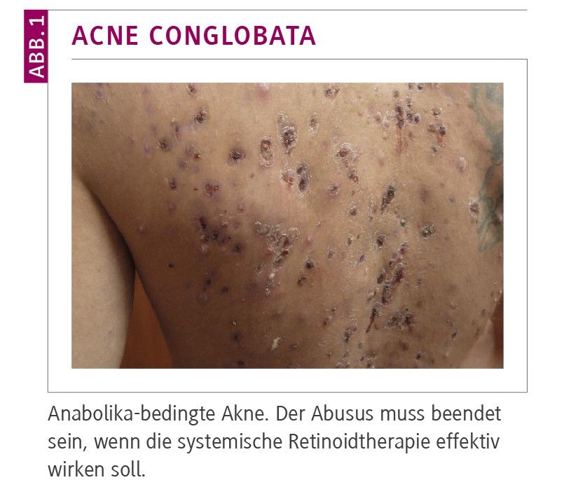 Acne conglobata, Mykosen und Urtikaria polypragmatisch therapieren