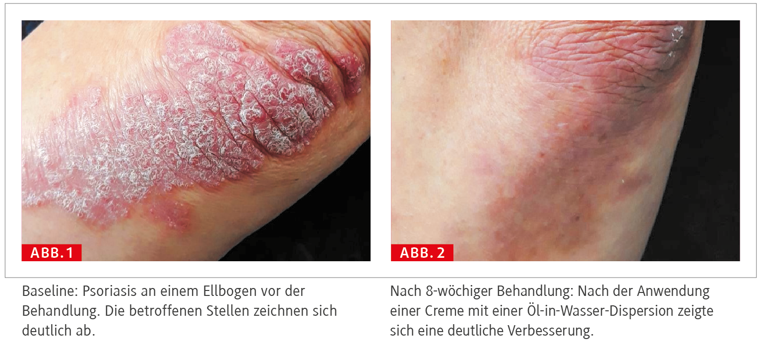 Goldstandard bei der topischen Therapie