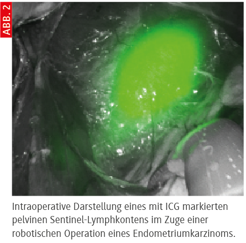 Robotische Operation des Endometriumkarzinoms