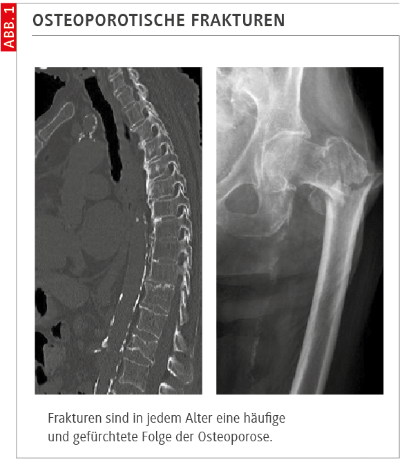 Osteoporose bei jungen untergewichtigen Frauen