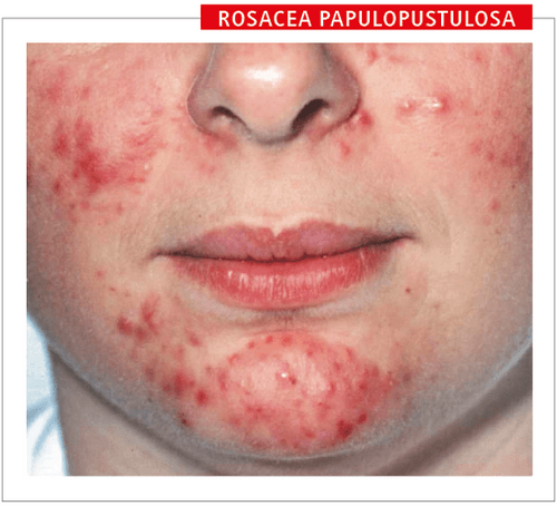Rosacea - Abgrenzen zu Lupus und Akne