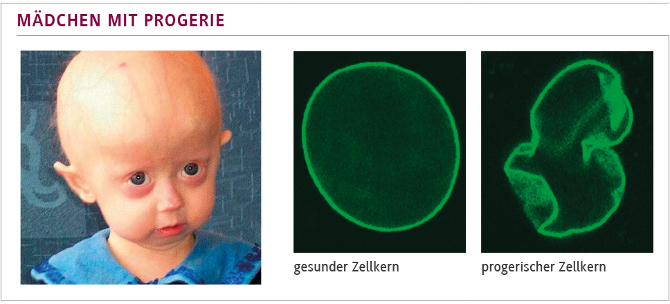 Vergreisung durch fehlgefaltetes Protein