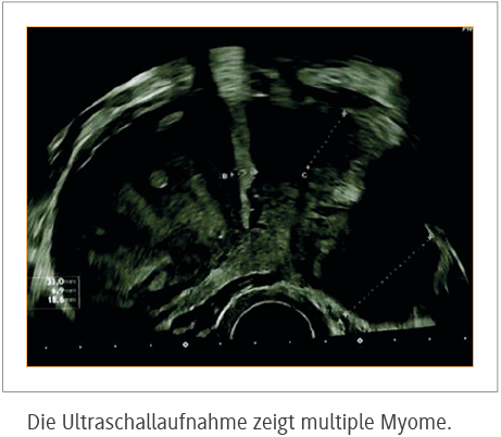 Relugolix-Kombinationstherapie bei myomassoziierter Anämie