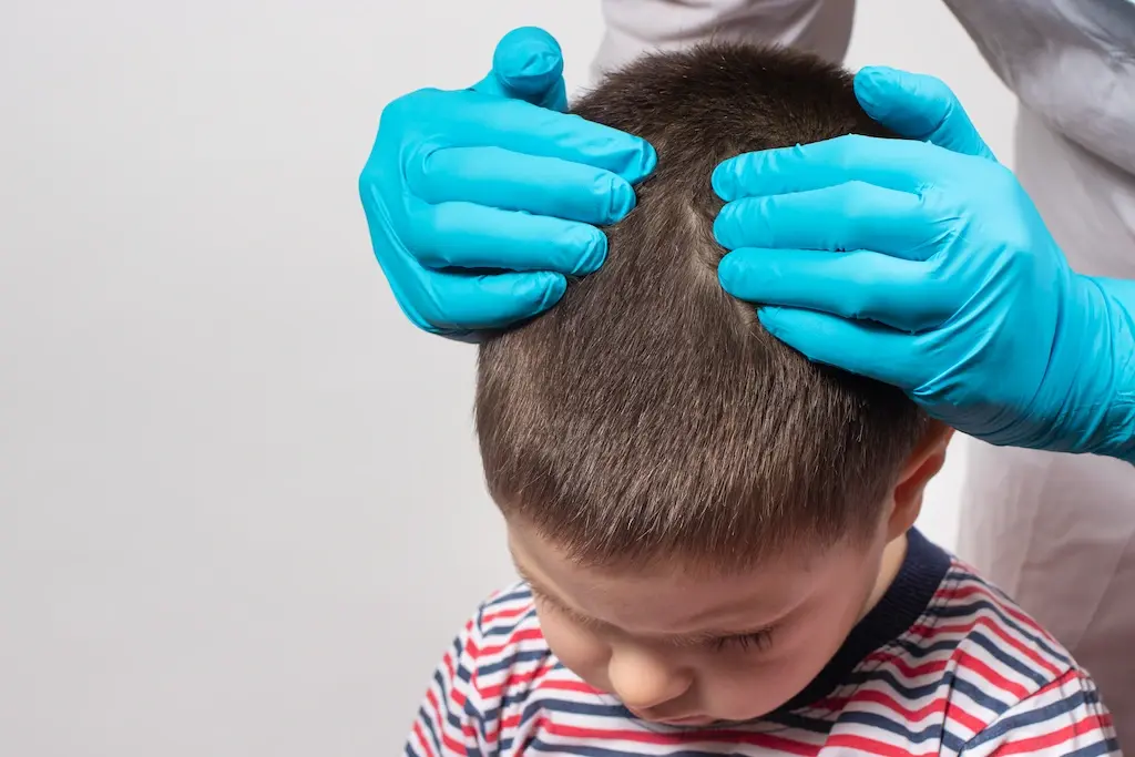 4 Reasons Why Your Head Still Itch After Lice Treatment | LiceDoctors ...