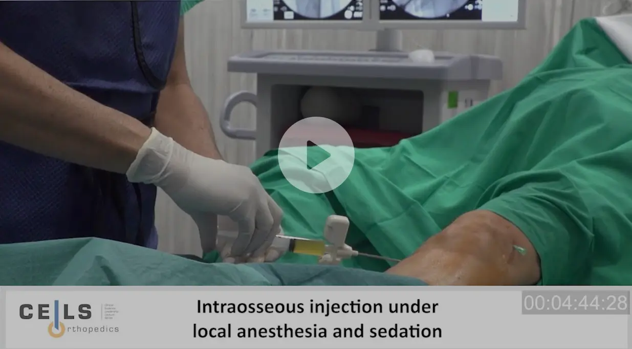 CELLS Webinar: Intraosseous PRP for Knee OA | RegenMed