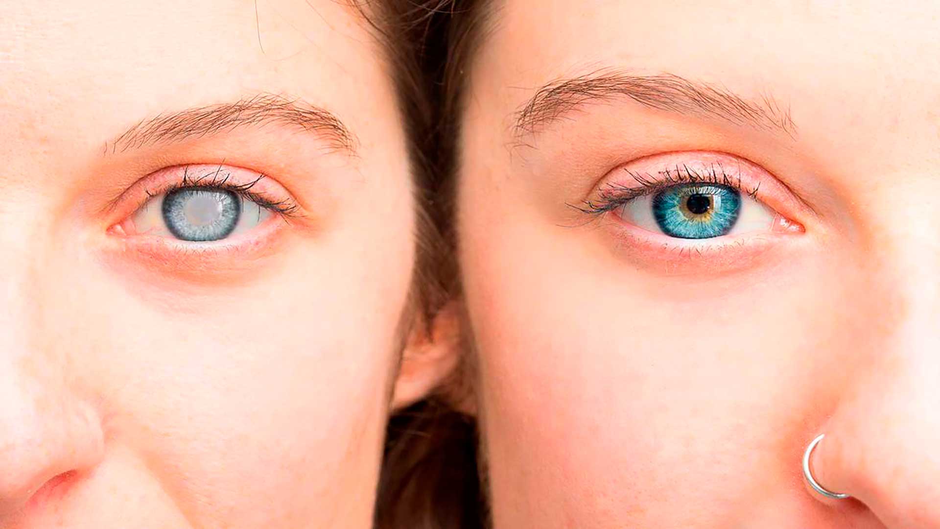 Catarata: o que é, diagnóstico e tratamento