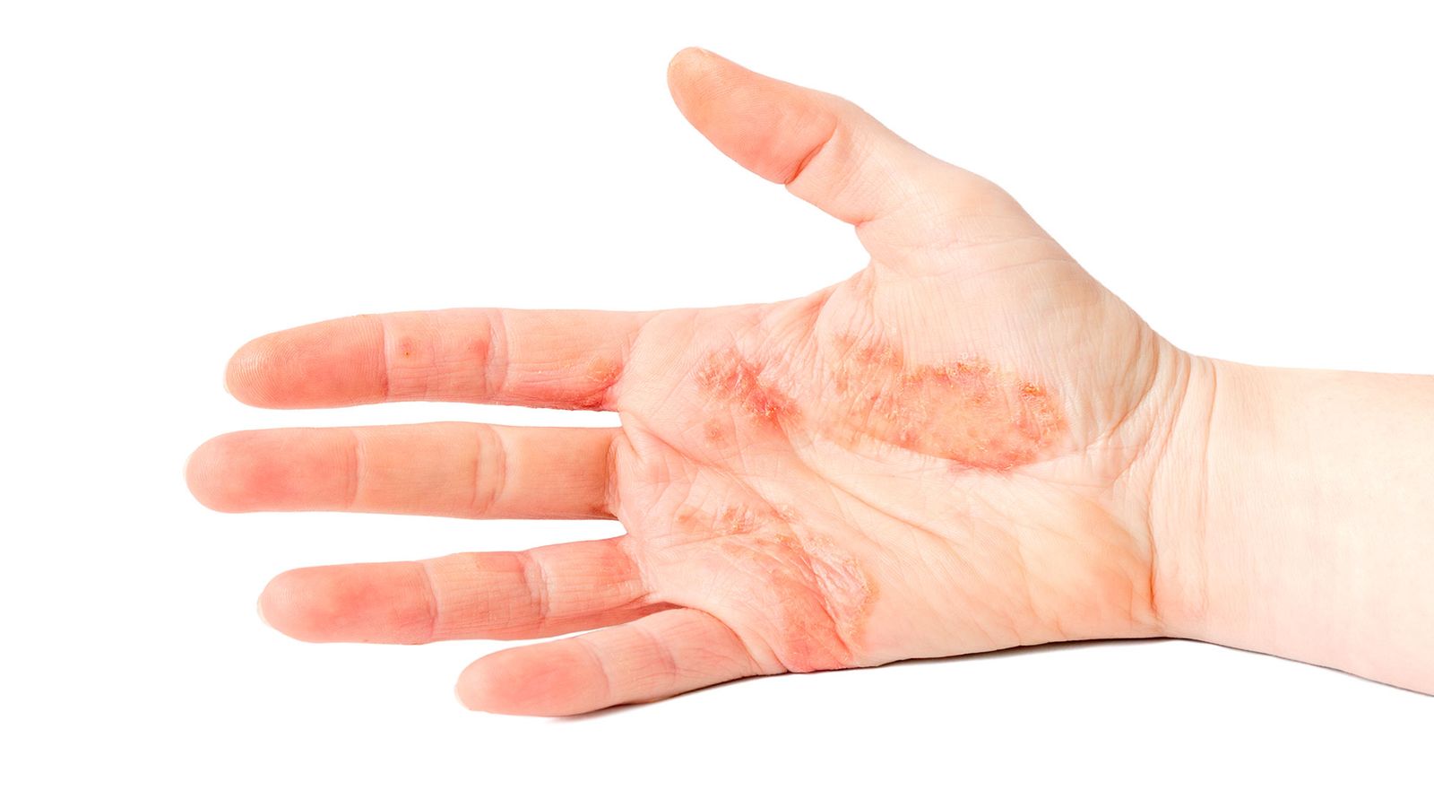 Disidrose: o que é, diagnóstico e tratamento