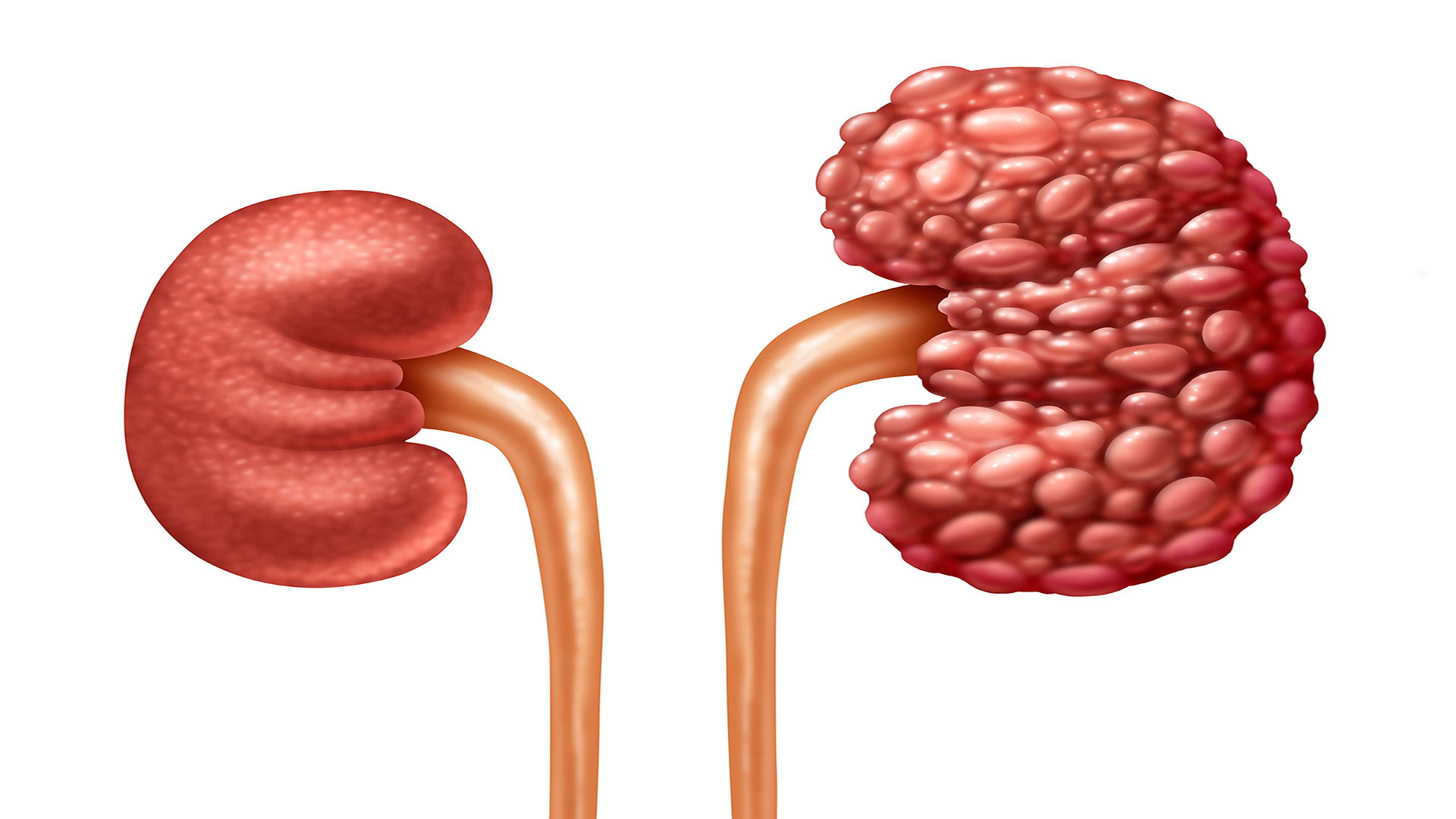 Rins Policísticos: O que é, causas e Como funciona