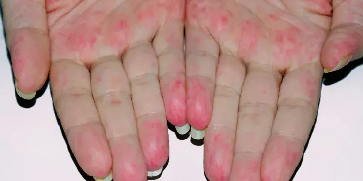 Vasculite: o que é, causas, sintomas e tratamento