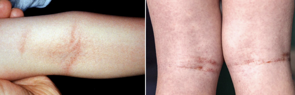 Escarlatina: causas, sintomas, diagnóstico e tratamento