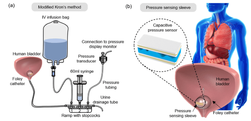 Síndrome compartimental abdominal: etiologia, diagnóstico e tratamento
