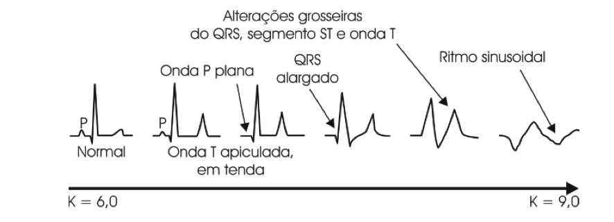 Hipercalemia: causas, fisiopatologia, sintomas e tratamento