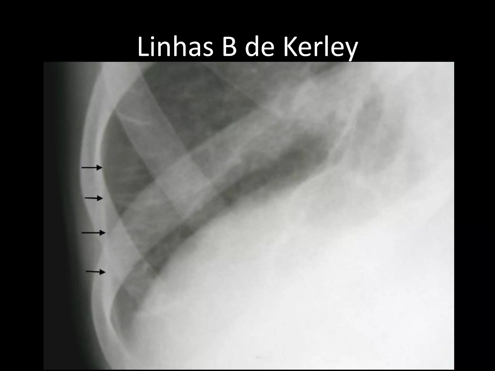 Edema Agudo de Pulmão: causas, diagnóstico e tratamento