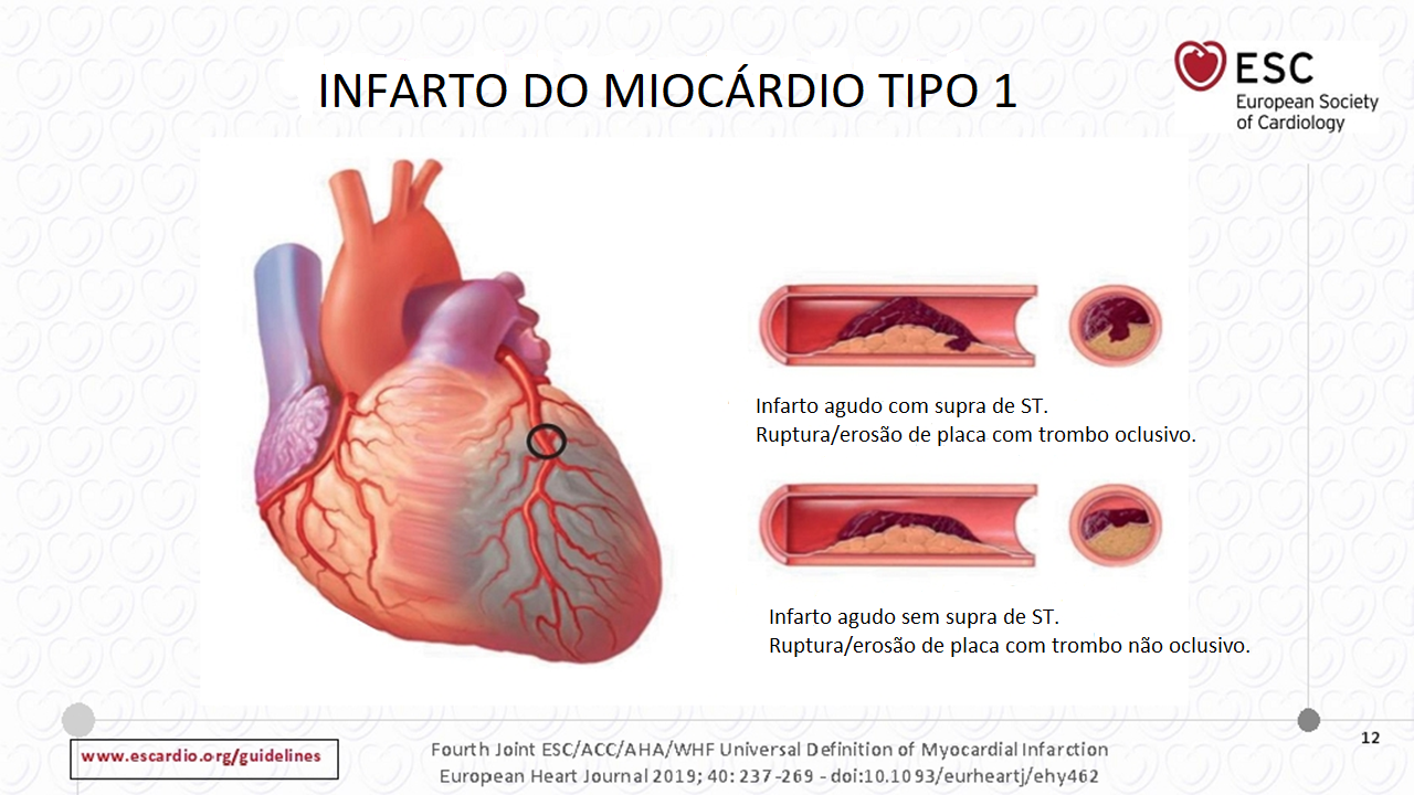 Infarto agudo do miocárdio: fisiopatologia, causas e sintomas