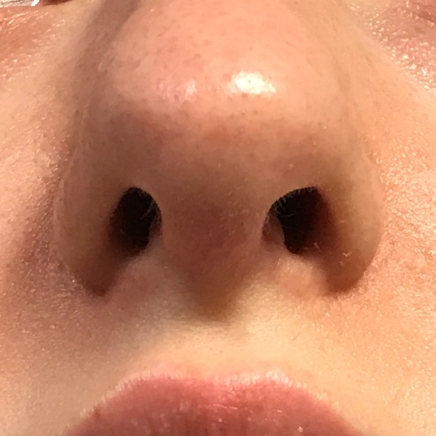 Scar Protocol | Best Scar Cream After Surgery