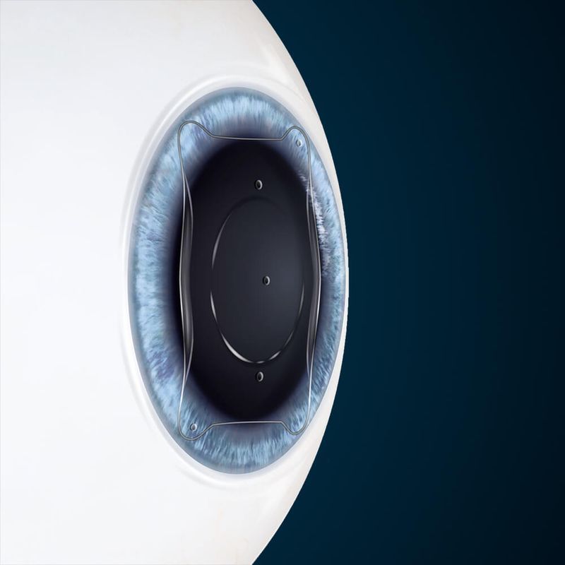 Implantable Contact Lens in San Antonio | San Antonio Eye Specialists