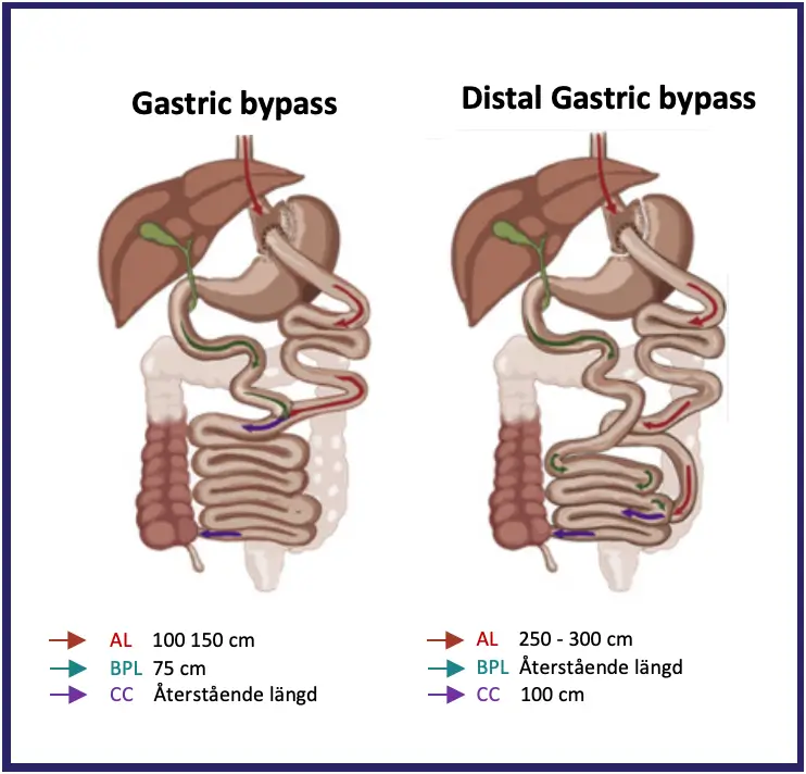Distal Gastric Bypass - Magsäcksoperation - Centrum för ViktMinskning