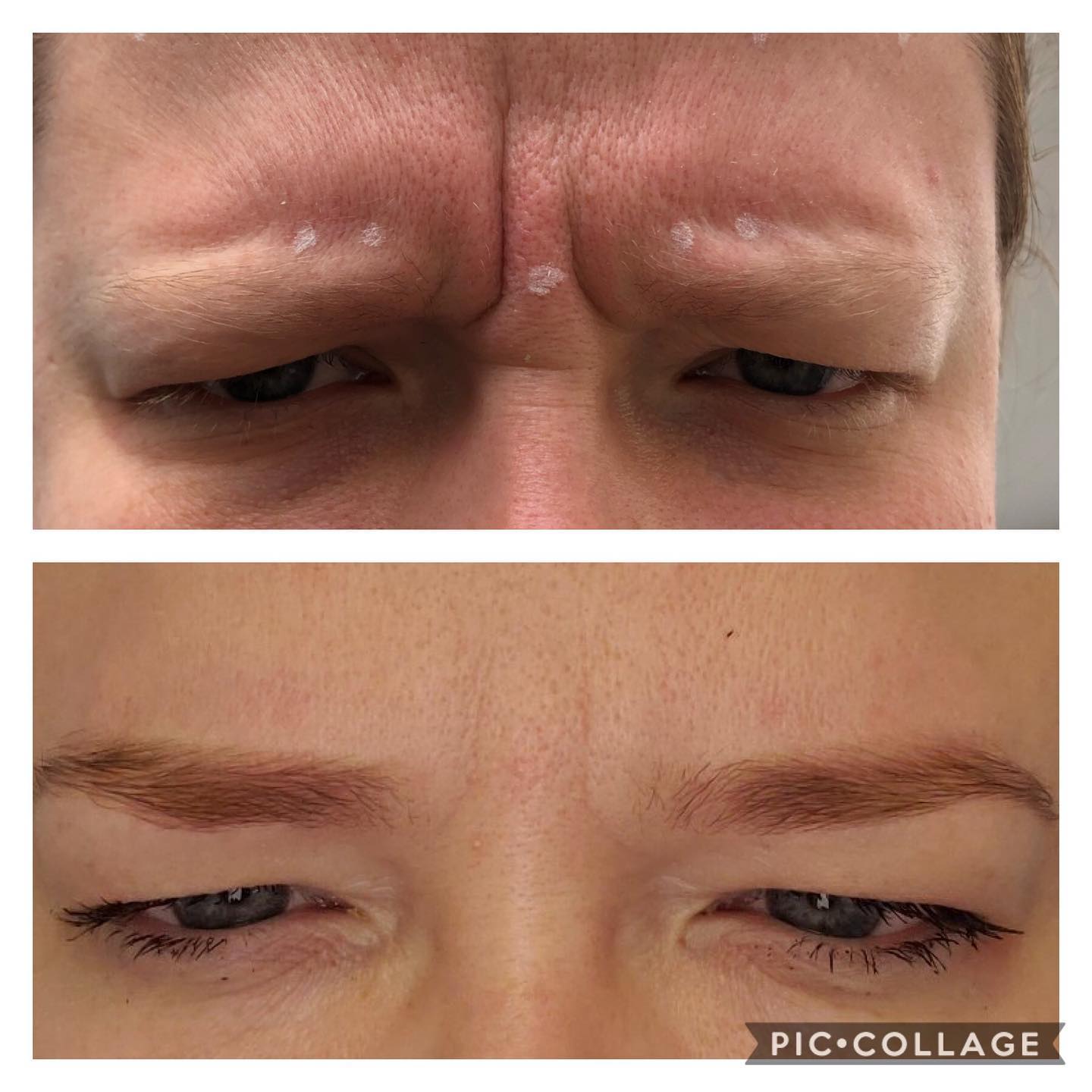 Botox In Collingwood | LYFT Medical Aesthetics