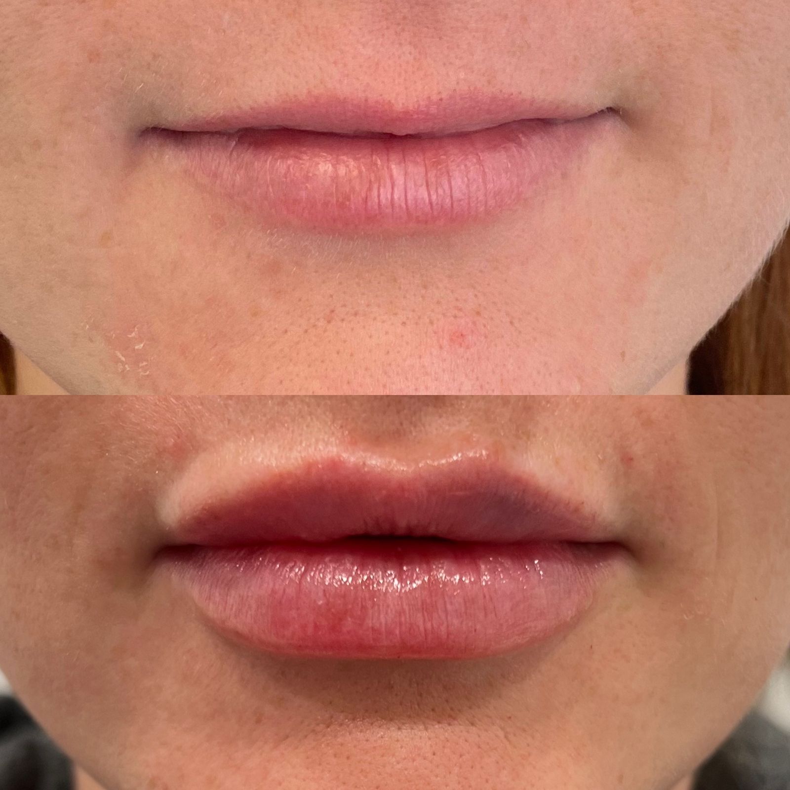 Lip Enhancement, Collingwood | LYFT Medical Aesthetics | Lip Augmentation