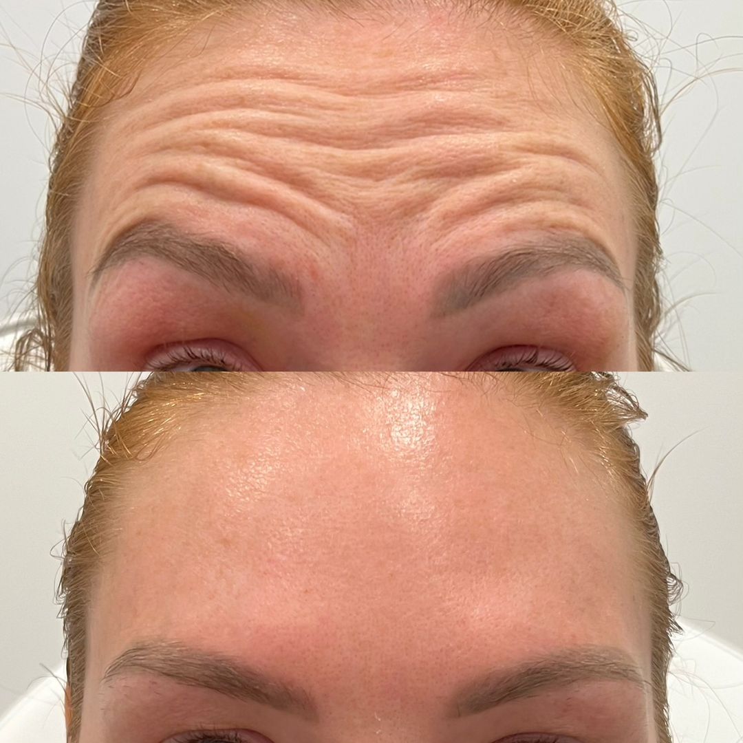 Botox In Collingwood | LYFT Medical Aesthetics