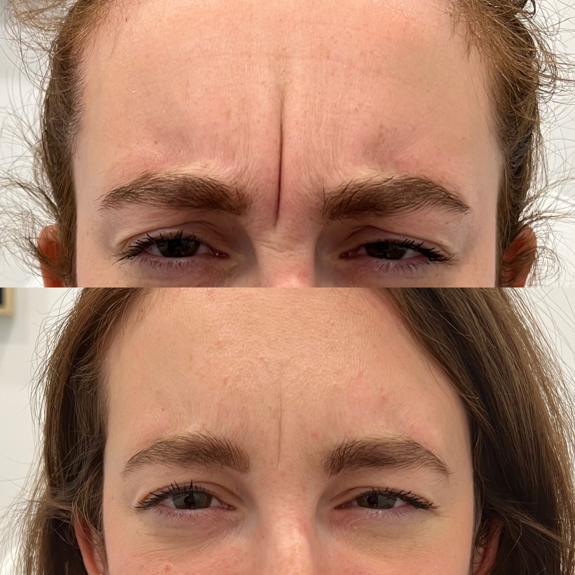 Botox In Collingwood | LYFT Medical Aesthetics