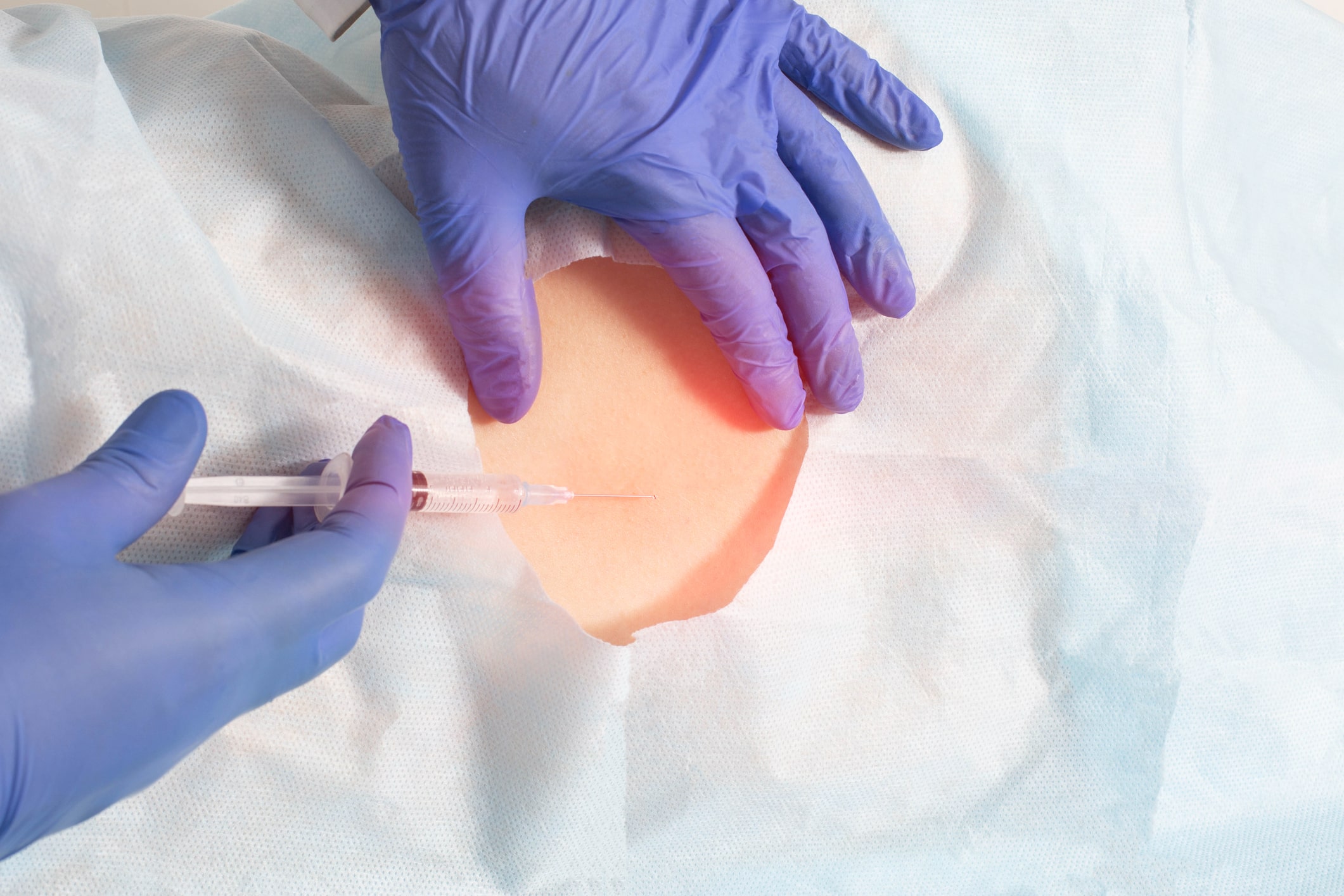 Nerve Root Block Injection – Treatments | One Health Group