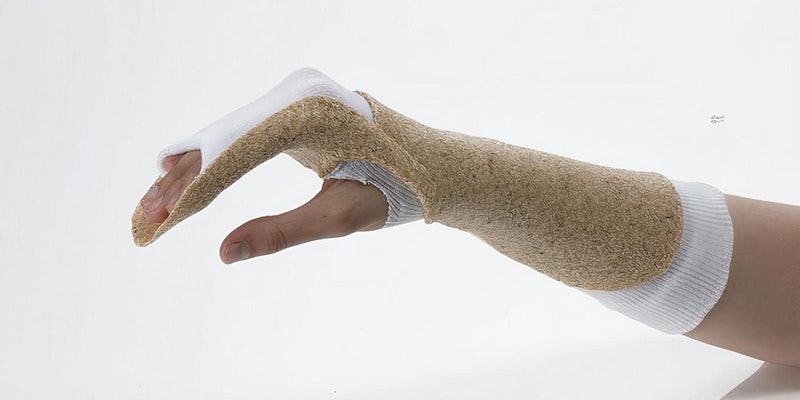 Woodcast for Hand Therapy