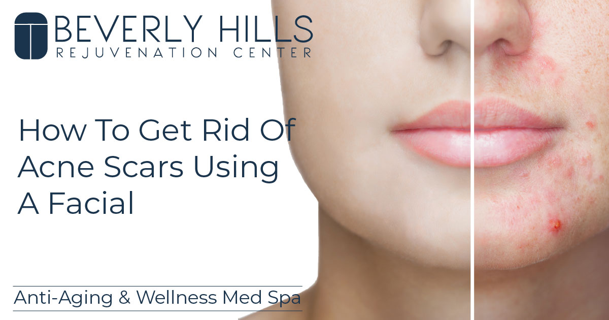 How to Get Rid of Acne Scars | BHRC Med Spa Blog